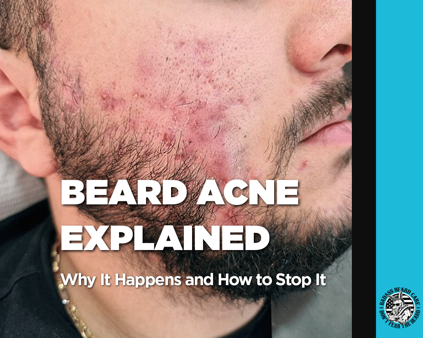 Beard Acne Explained: Why It Happens and How to Stop It – Badass Beard Care